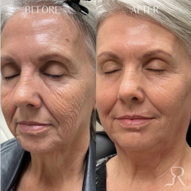 Pix:E RF Micro needling - Infuzed IV Bar