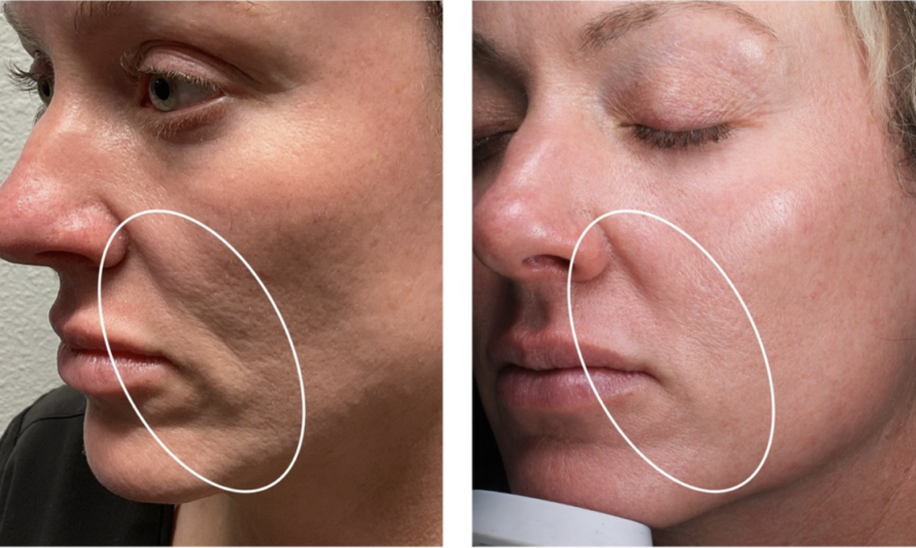 Pix:E RF Micro needling - Infuzed IV Bar